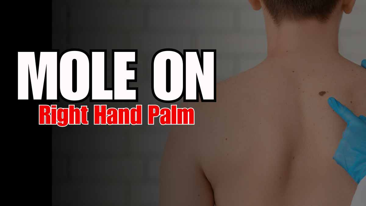 Mole on Right Hand Palm – Meaning & Life Predictions - Astrodeep - Best ...
